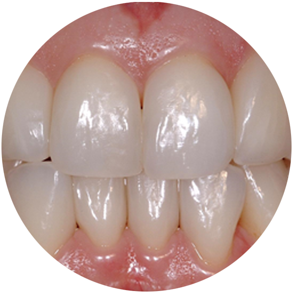 Dental CE: Anterior Matrix Techniques for Predictable Restorations ...