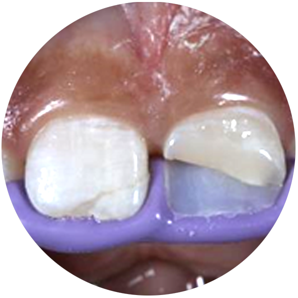 Universal Esthetic Composite – CRD Continuing Education